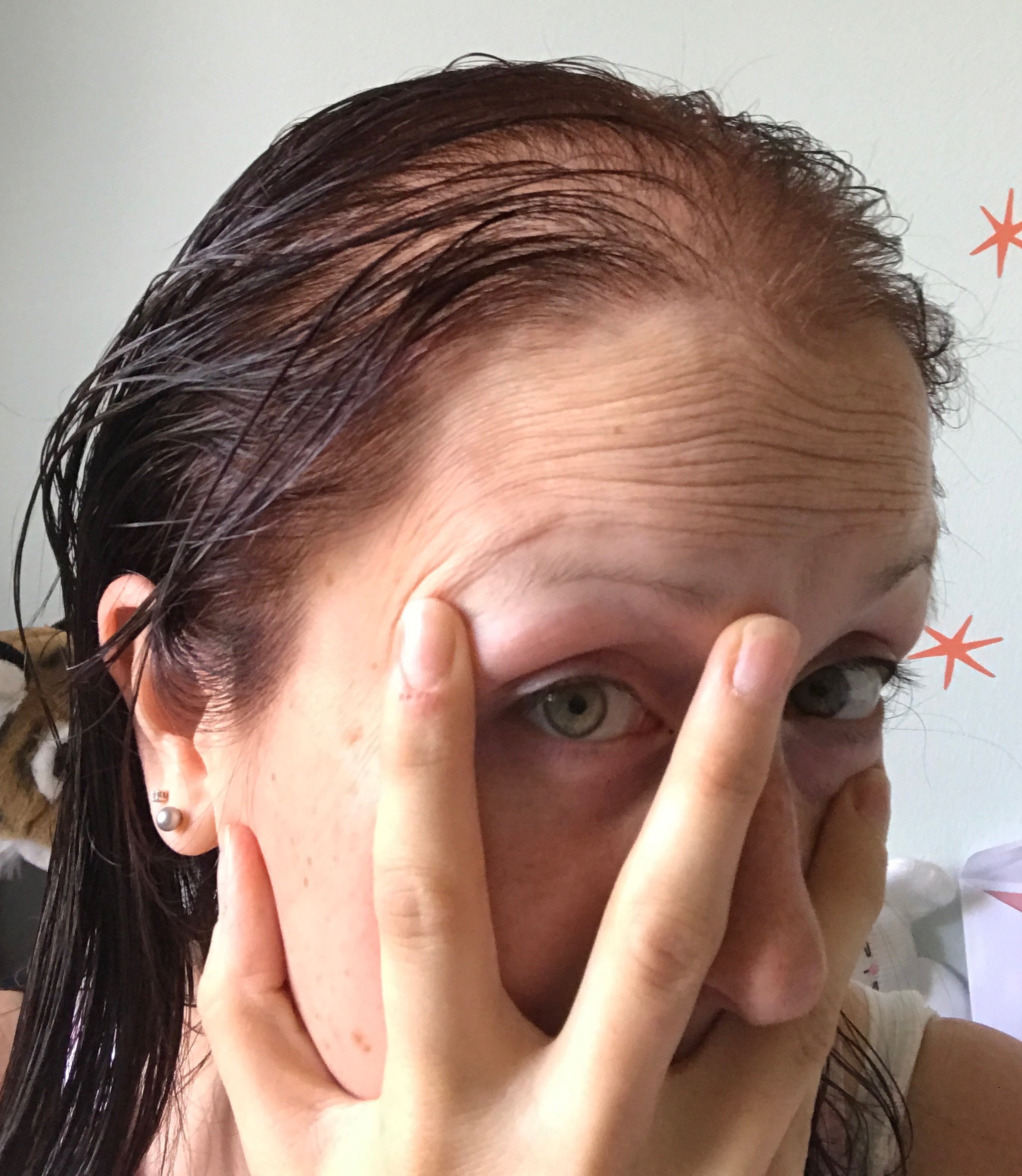 Alopecia advice: Pattern Hair Loss – HerHairMyHead